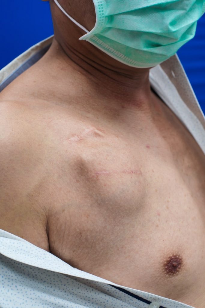 Implanting a Pacemaker | My Rhythm Device