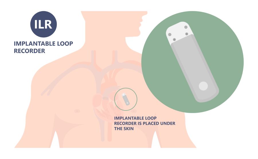 Implantable Heart Rhythm Monitor My Rhythm Device