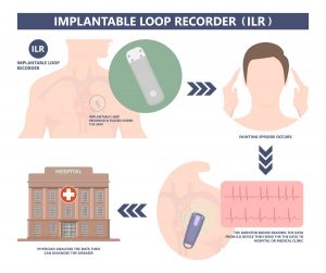 Implantable Heart Rhythm Monitor (ILR) | My Rhythm Device