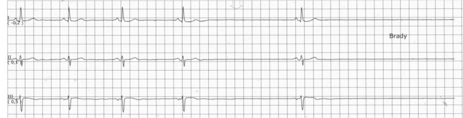 When Do I Need a Pacemaker? | My Rhythm Device