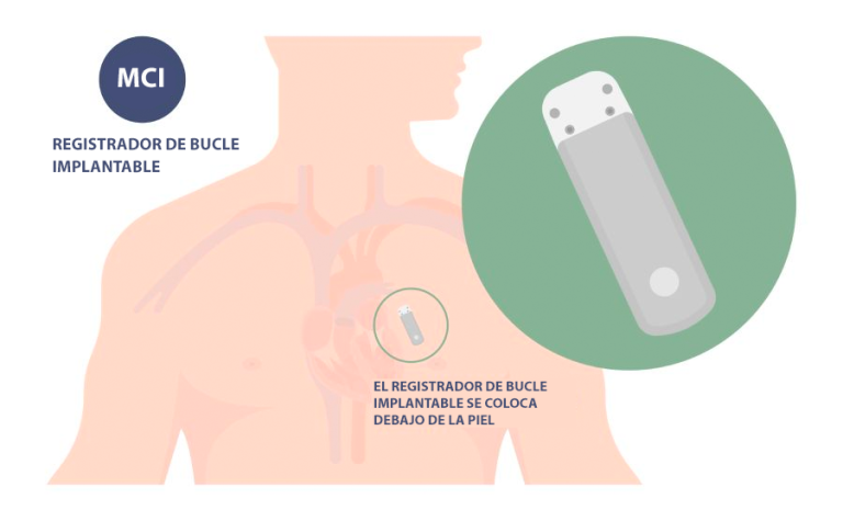 Monitor de ritmo cardíaco implantable | My Rhythm Device